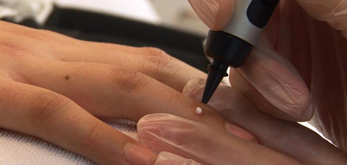 CryoPen Cryotherapy - Vanité Clinic Solihull