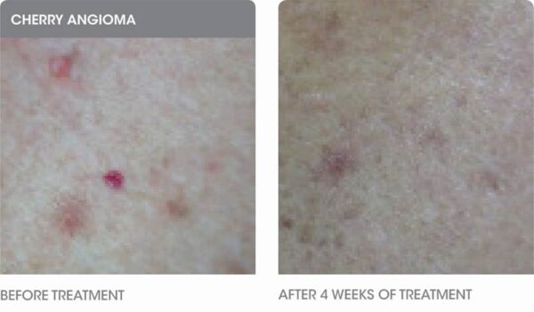 CryoPen Cryotherapy – Vanité Clinic Solihull