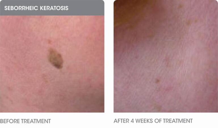 CryoPen Cryotherapy – Vanité Clinic Solihull